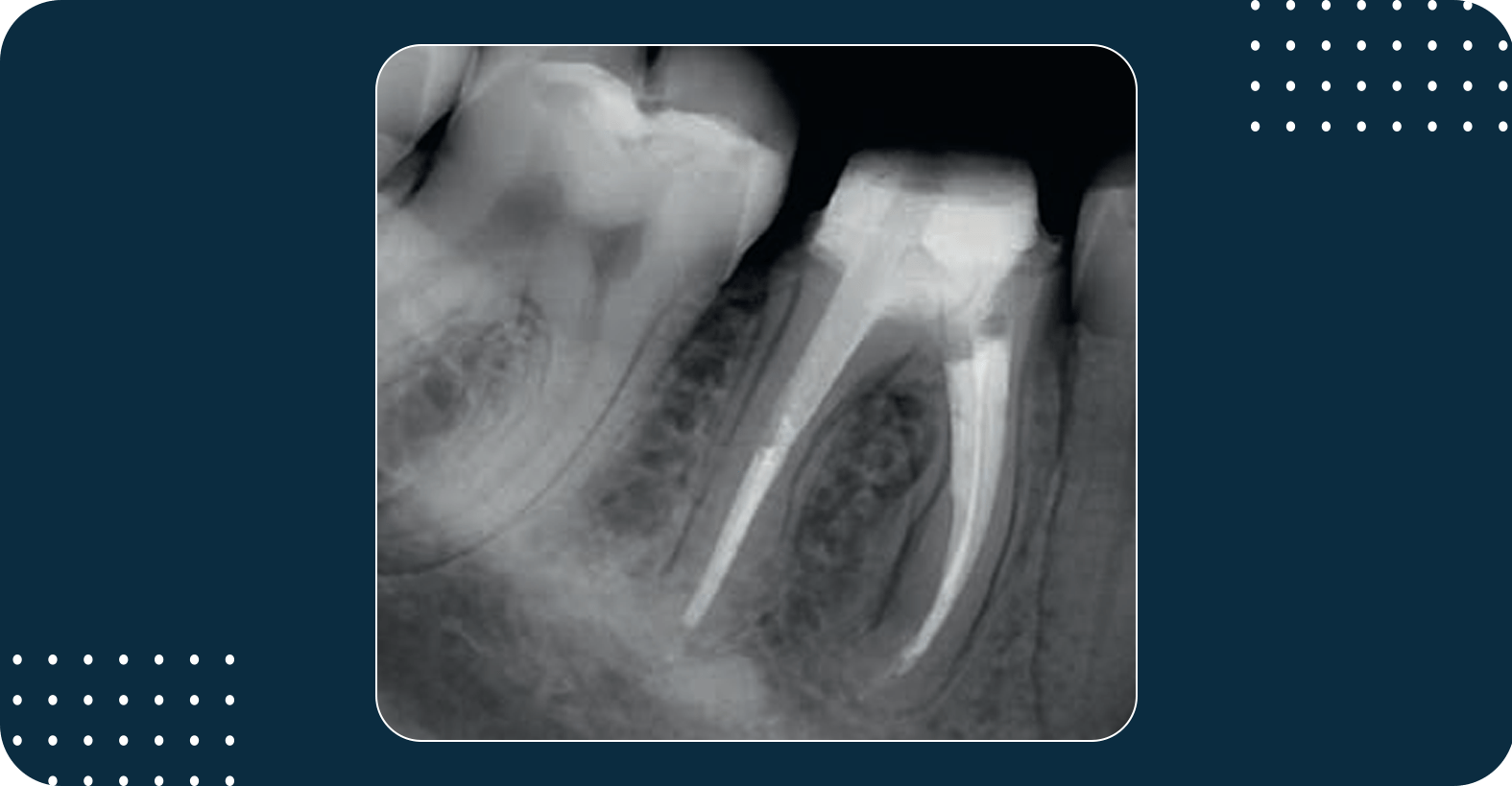Clinical case on using BioRoot RCS for root canal filling