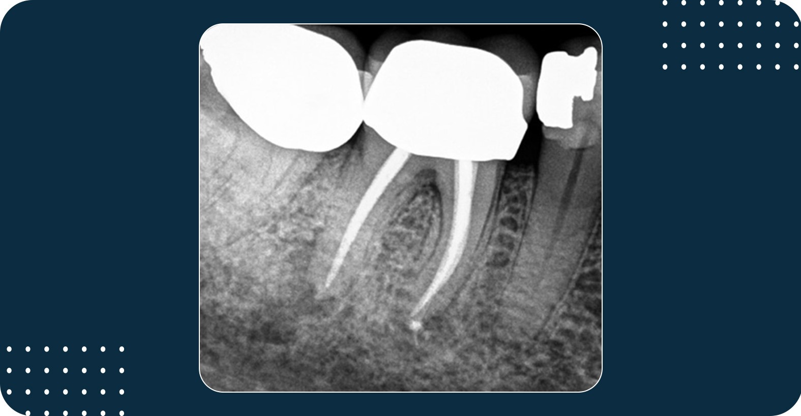 Root Canal Re-Treatment Success with BioRoot Flow - Septodont USA