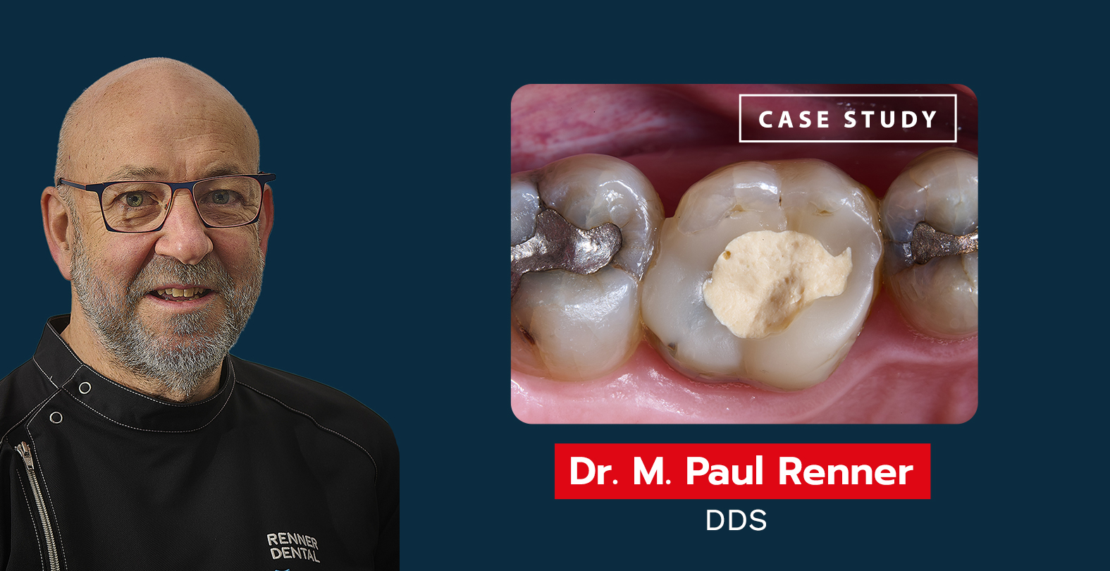Case Study on Biodentine® "Bio-Bulk Fill & crown placement" - Septodont USA