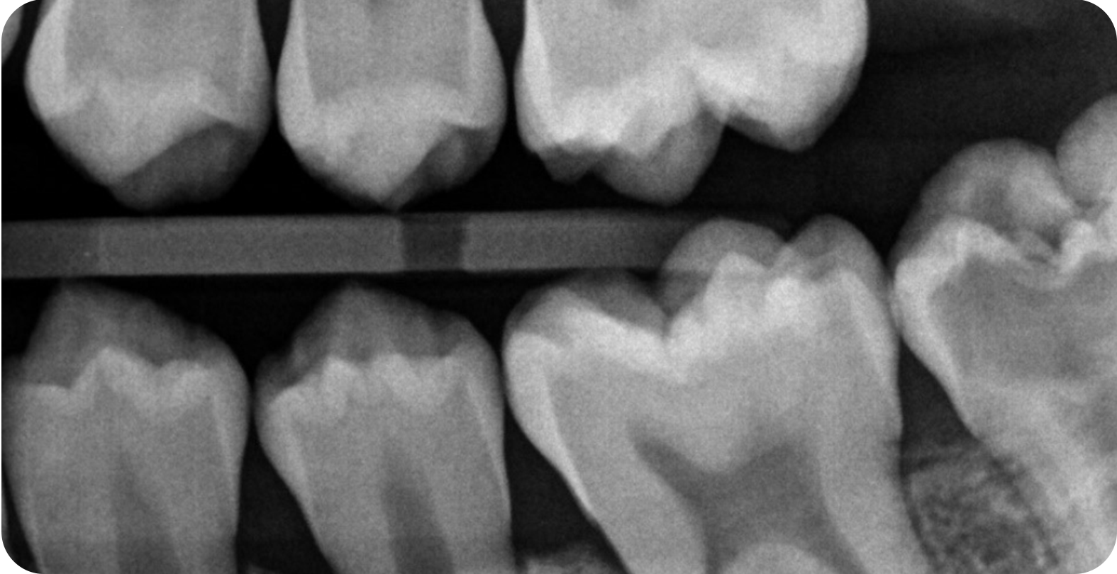 Full pulpotomy using Biodentine® XP on an immature tooth with pre ...